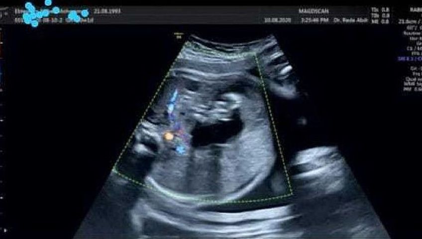 Lekarze odkryli płód w brzuchu noworodka. To tzw. potworniak | WP parenting