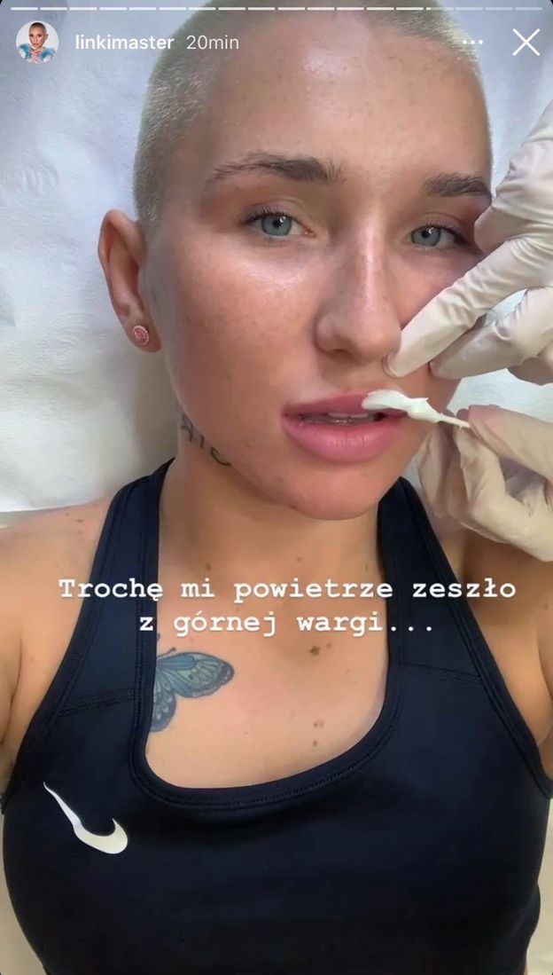 Marta Linkiewicz podpompowuje "krzywą wargę": "Powietrze zeszło" (FOTO ...