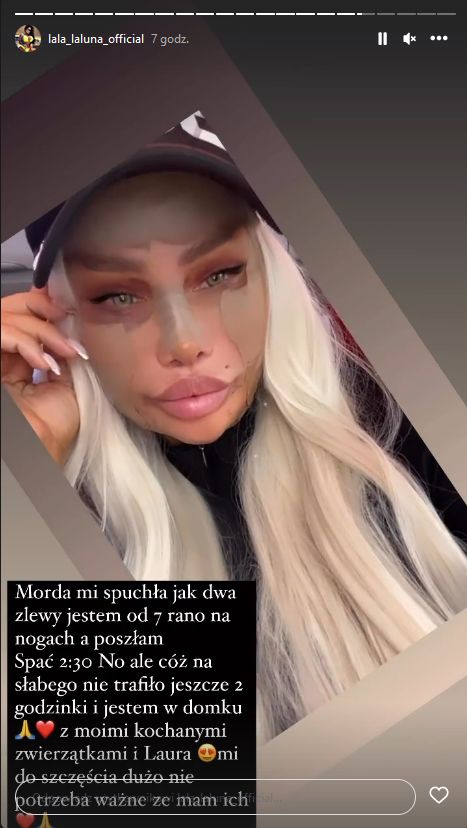 Laluna Unique pokazała efekty kolejnych operacji. Tak teraz wygląda ...