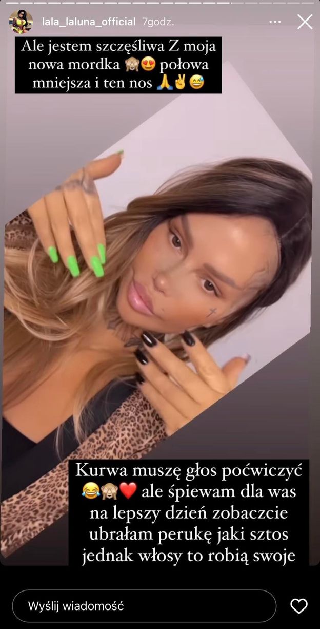 Laluna Unique pokazuje twarz po operacji i narzeka na Polaków! - Pudelek
