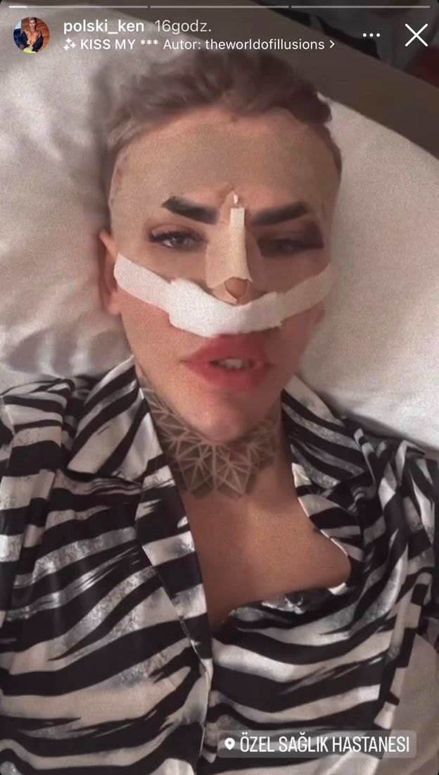 Polski Ken znów majstrował przy twarzy. Tak wygląda po operacji - Pudelek