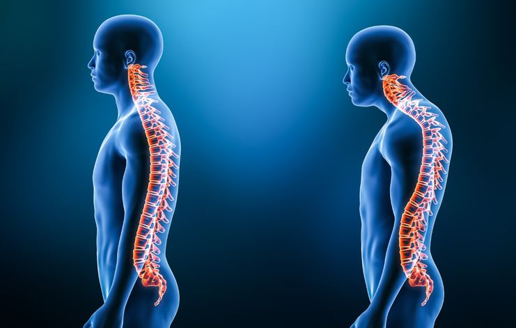 Kifoza - przyczyny, objawy, rozpoznanie, leczenie | WP abcZdrowie