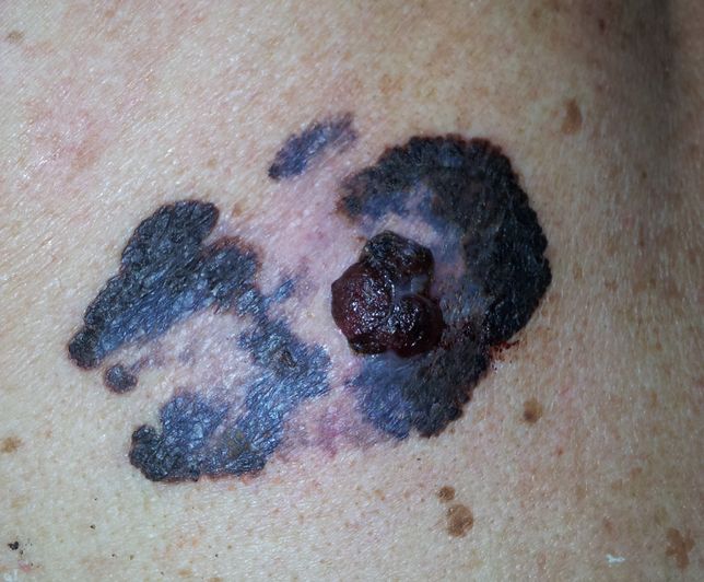 Czerniak. Wszystko co trzeba wiedzieć o jednym z najbardziej złośliwych ...