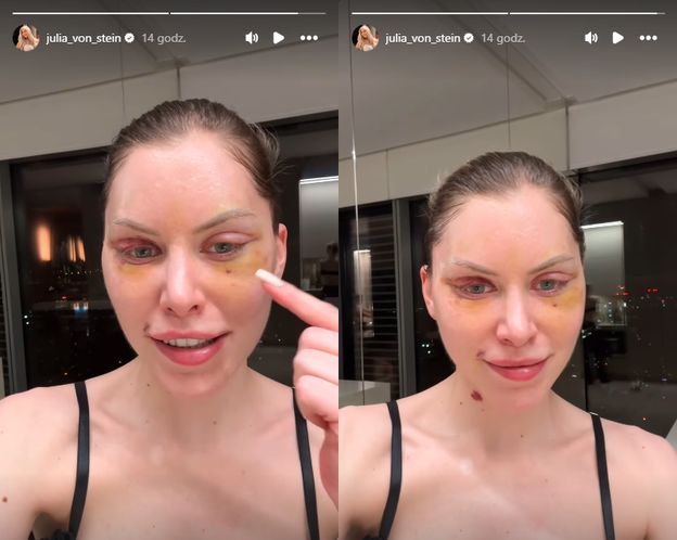 Julia von Stein pokazała się 8 dni po operacji. "Siniaczków jest pełno" - Pudelek