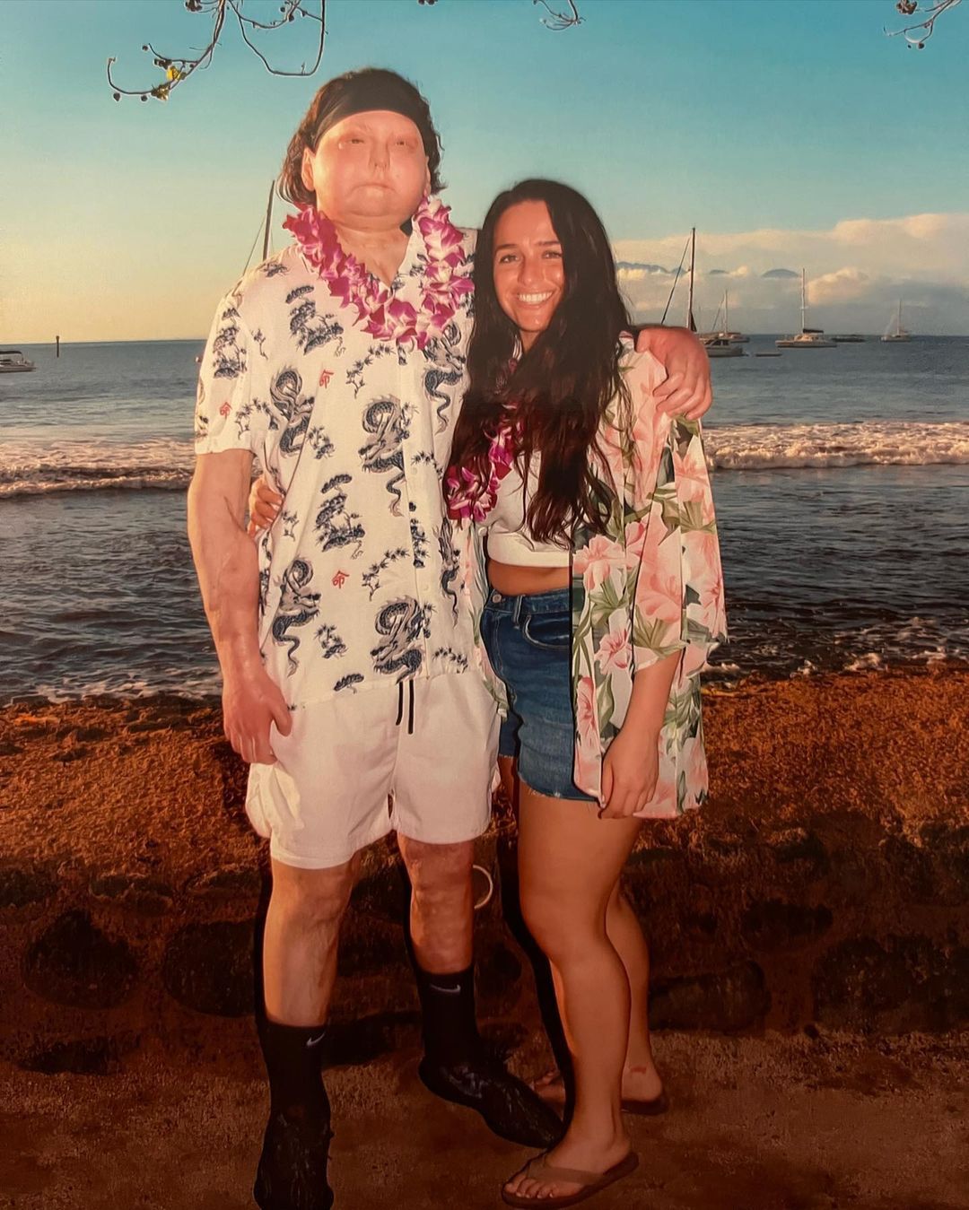 Przeszczepili mu twarz dwa razy starszego mężczyzny. Jak dziś wygląda ...