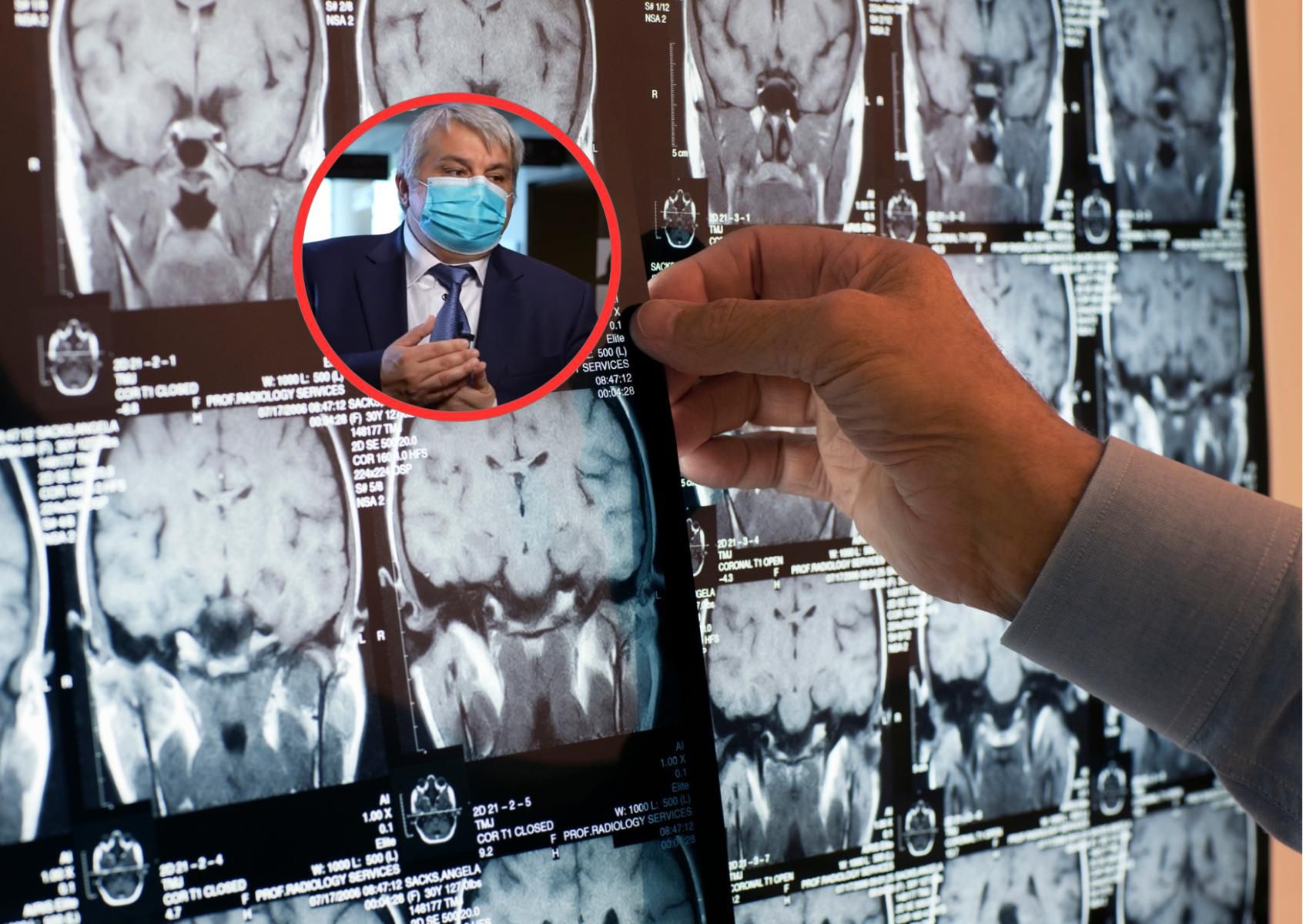 Zbadali mózgi osób po udarze. Ustalili, co do niego doprowadziło