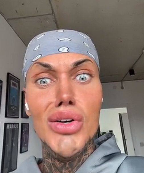 Ma za sobą 15 operacji plastycznych. Tak wygląda jego twarz. Auć! - Pudelek