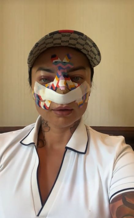 Kamila Wybrańczyk zrobiła sobie NOWY NOS. "35 TYSIĘCY i prawie żadnej ...