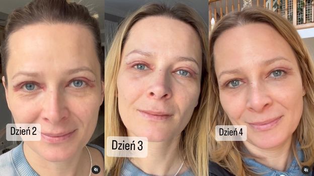 Moro przeszła zabieg! Pokazała rezultaty na Instagramie - Pudelek