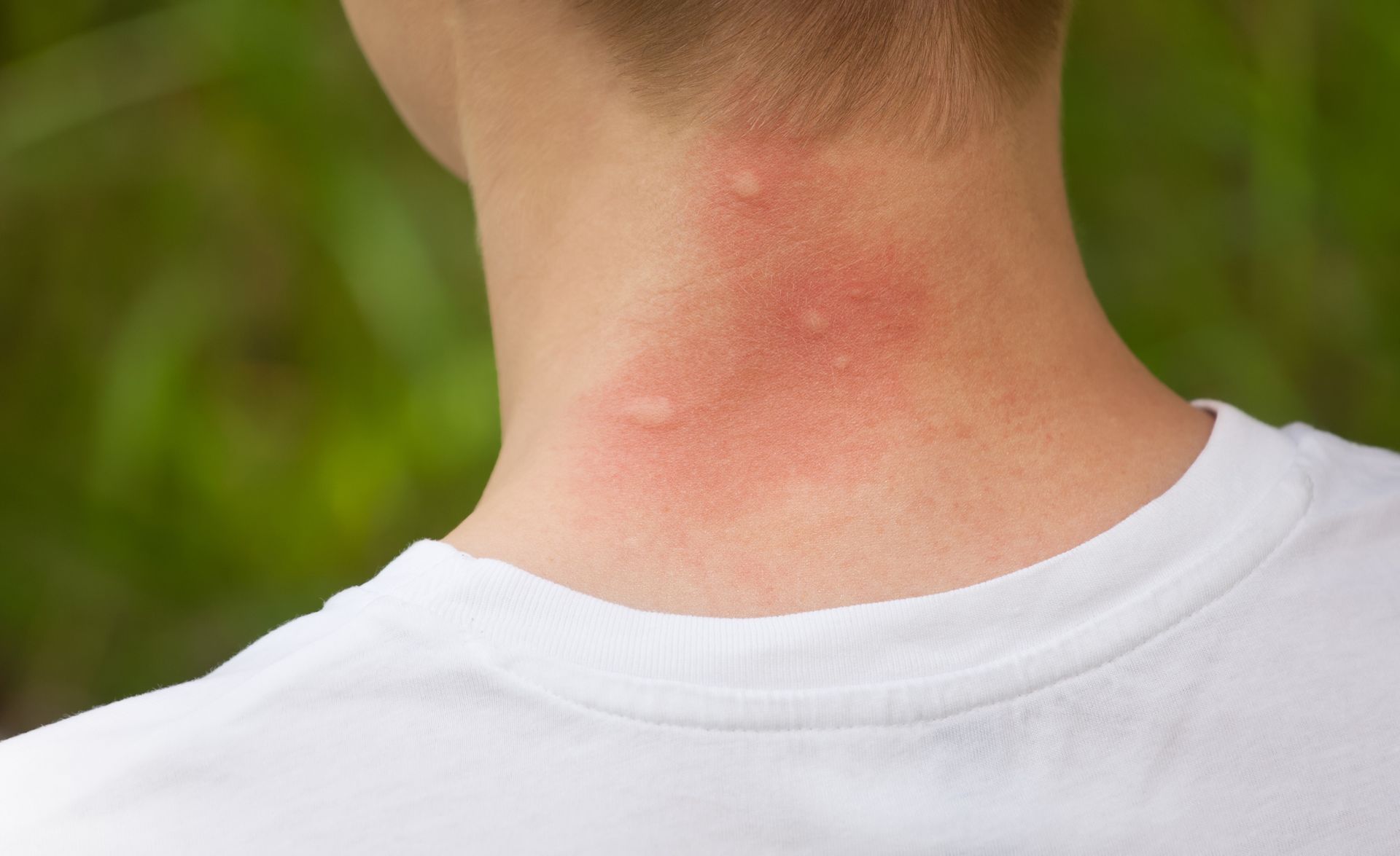Komary gryzą za "słodką krew"? Dermatolog wyjaśnia mit