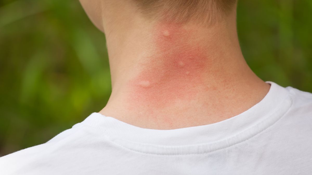 Komary gryzą za "słodką krew"? Dermatolog wyjaśnia mit