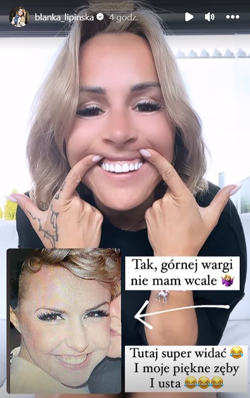 Blanka Lipińska tłumaczy internautom, co się stało z jej górną wargą ...
