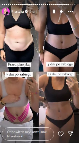 Lili Antoniak z "Gogglebox" przeszła plastykę brzucha. Pokazała efekty - Pudelek